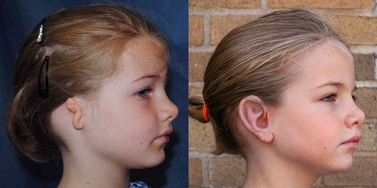 Before & After Photos - Lewin Ear Reconstruction
