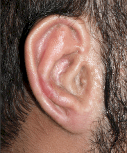 Surgery - Lewin Ear Reconstruction