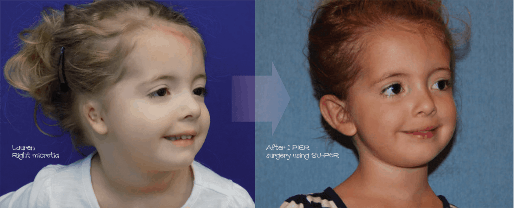 PIER vs Rib Cartilage - Lewin Ear Reconstruction