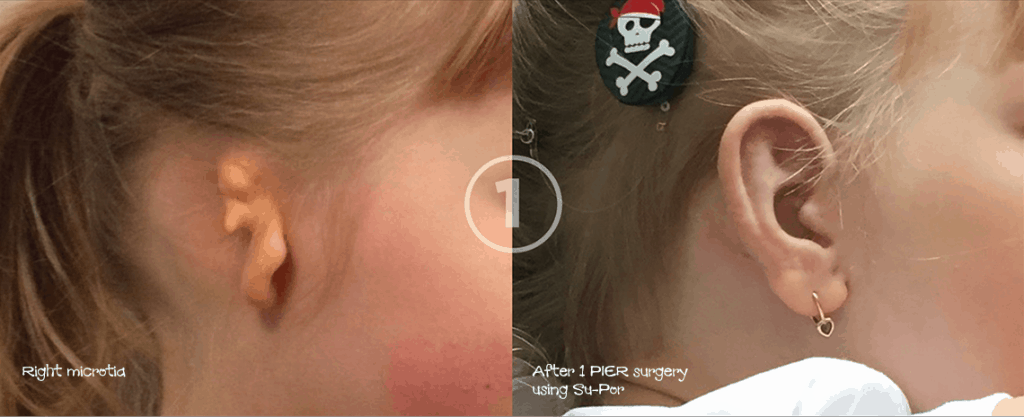 PIER vs Rib Cartilage - Lewin Ear Reconstruction