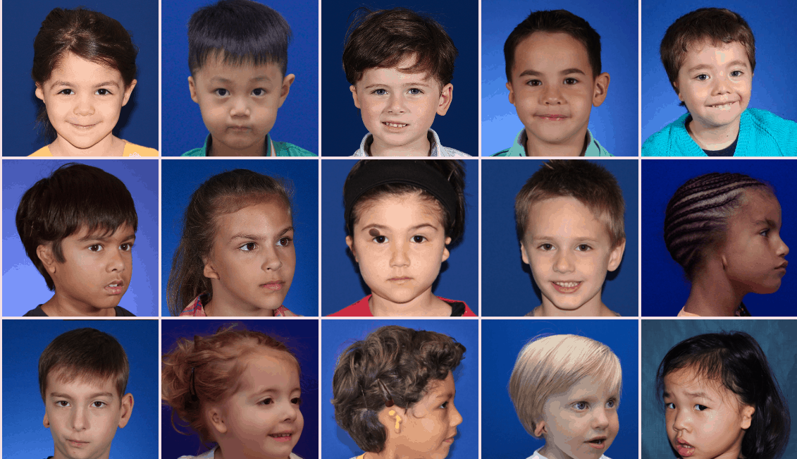 Photos - Lewin Ear Reconstruction